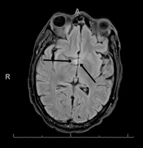 Neuromyelitis Optica with Hypercapnic Respiratory Failure