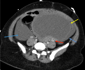 Case of Ruptured Endometrioma