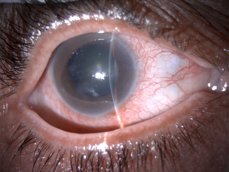 Olanzapine-induced acute angle closure glaucoma