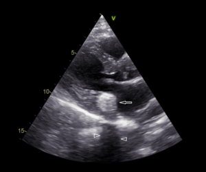 Caseous Calcification of Mitral Annulus