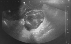 Pyosalpinx - Medical Cases- MEDizzy