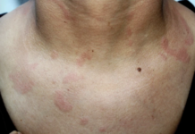 Lupus Erythematosus Tumidus - MEDizzy Journal