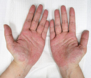 Case of Palmar Erythema during Pregnancy