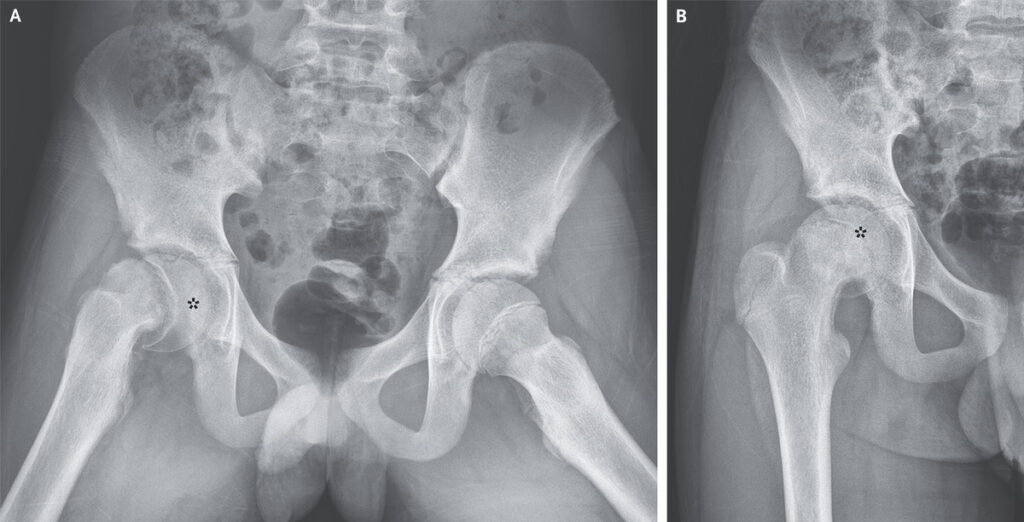 Slipped Capital Femoral Epiphysis