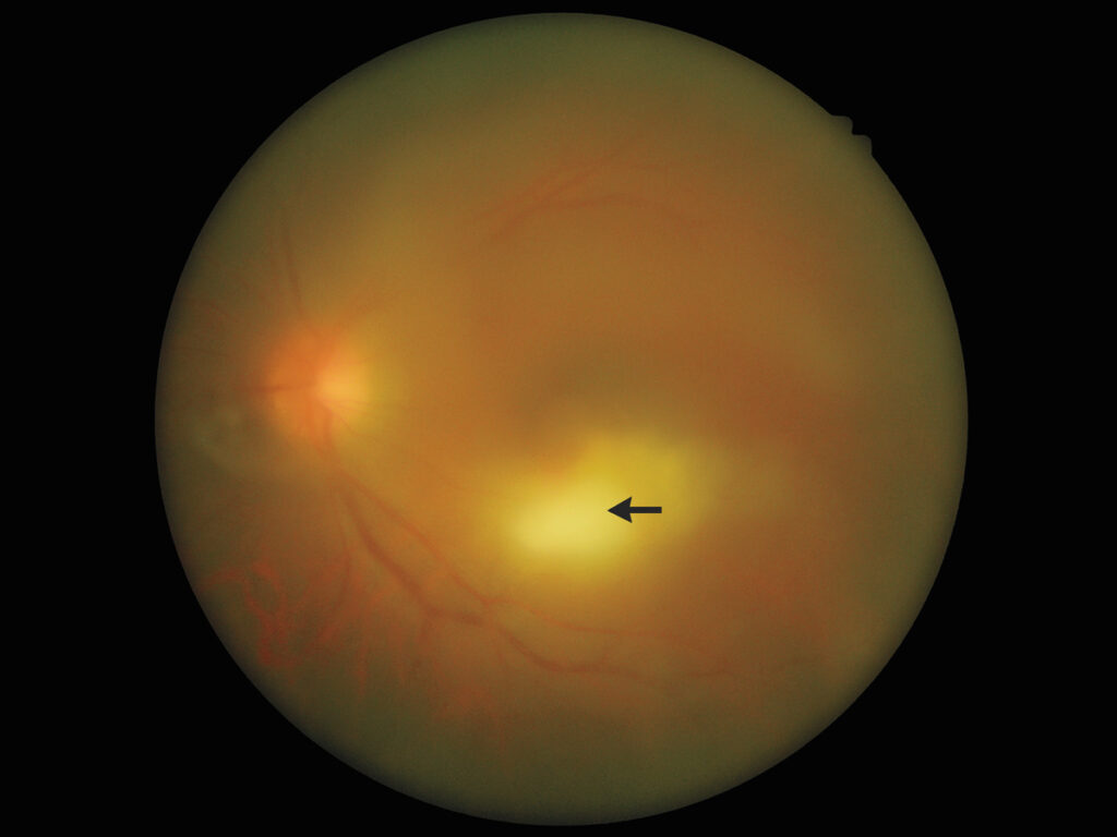 Case of Acute Ocular Toxoplasmosis
