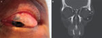 Case of Orbital Emphysema