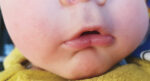 Case of 4-Month-Old with Hereditary Geniospasm