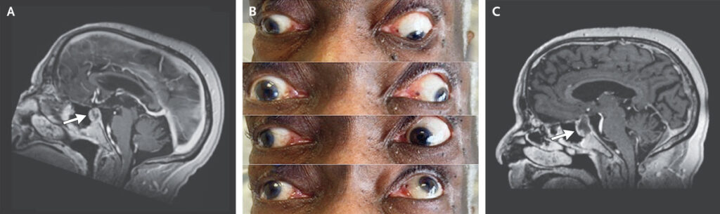 Pituitary Apoplexy in an 81-Year-Old