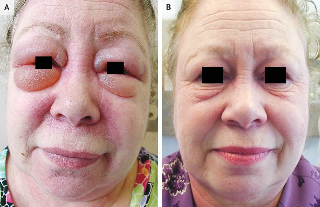 Periorbital Edema in Dermatomyositis