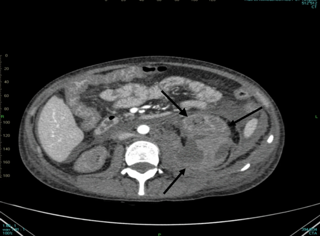 Rare complication of Kidney Biopsy - MEDizzy Journal