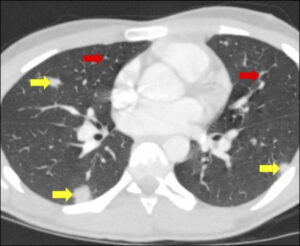Case Report: Necrobiotic Pulmonary Nodules in Ulcerative Colitis ...