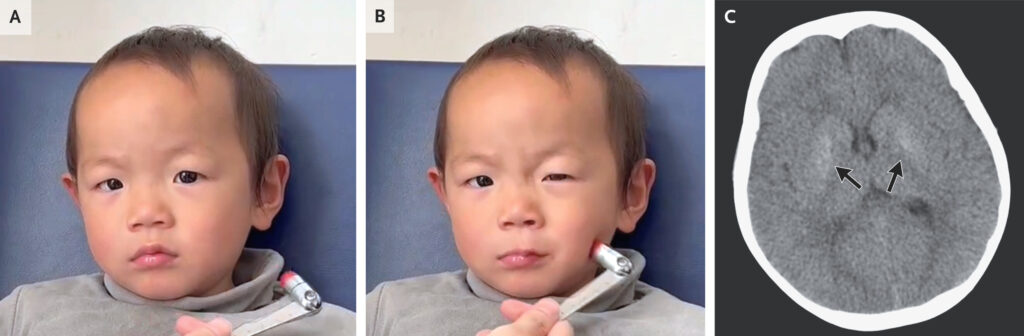 Case of Hypoparathyroidism and Chovtek's Sign