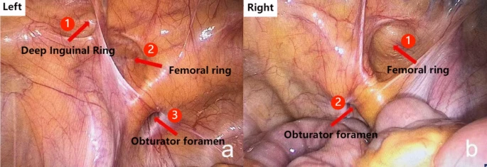 Incarcerated Obturator Hernia - MEDizzy Journal