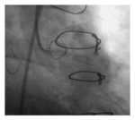 Acute Coronary Syndrome